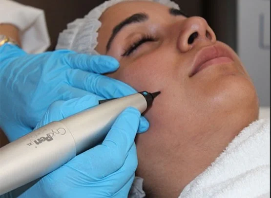 CryoPen — VISAGE AESTHETICS