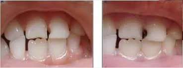 Silver Diamine Fluoride (SDF) — Western Dental Hygiene