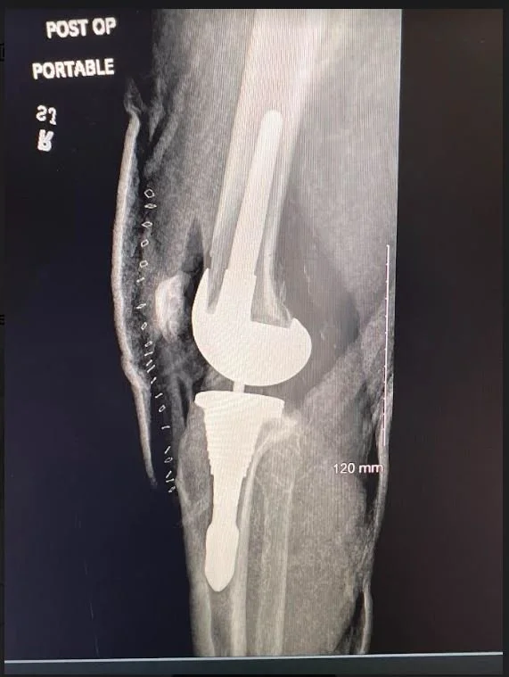 Knee surgery — Dr. Christopher Peer, MS, MD