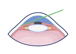 Selective Laser Trabeculoplasty — Dublin Eye Surgeon - Pavi Agrawal