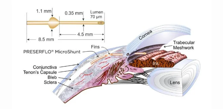 Preserflo Microshunt Surgery — Dublin Eye Surgeon - Pavi Agrawal