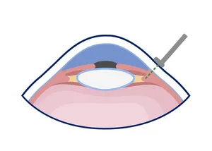 Laser Cycloablation — Dublin Eye Surgeon - Pavi Agrawal