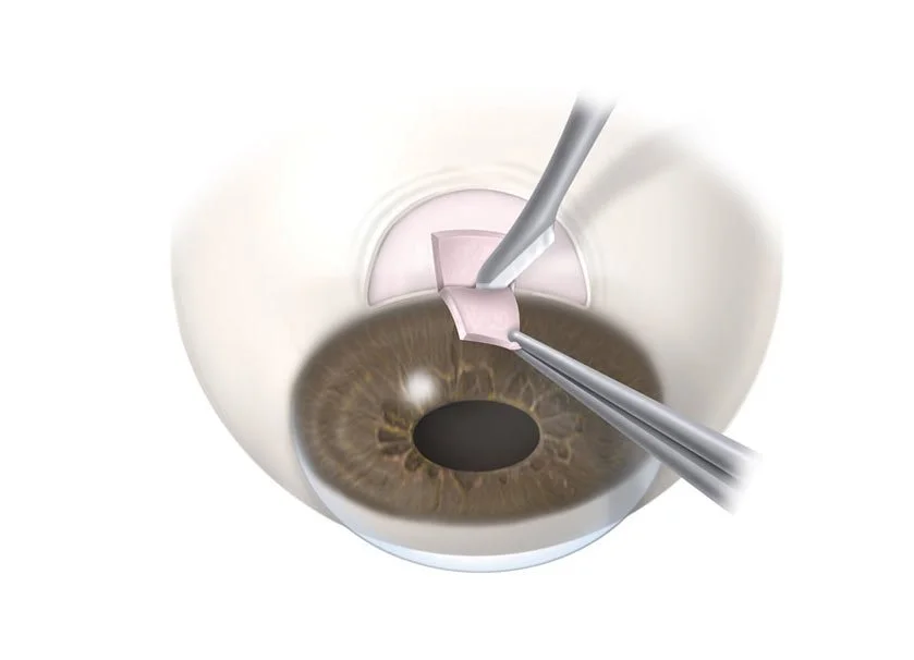 Trabeculectomy Dublin Eye Surgeon Pavi Agrawal Trabeculectomy Dublin Eye Surgeon Pavi Agrawal