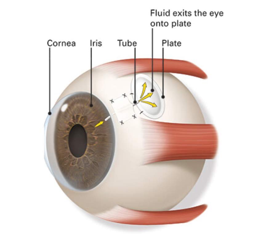 Aqeuous-Shunt Surgery — Dublin Eye Surgeon - Pavi Agrawal