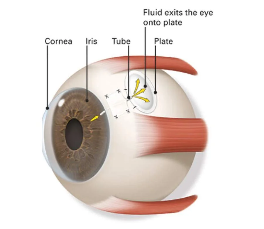 Aqeuous-Shunt Surgery — Dublin Eye Surgeon - Pavi Agrawal