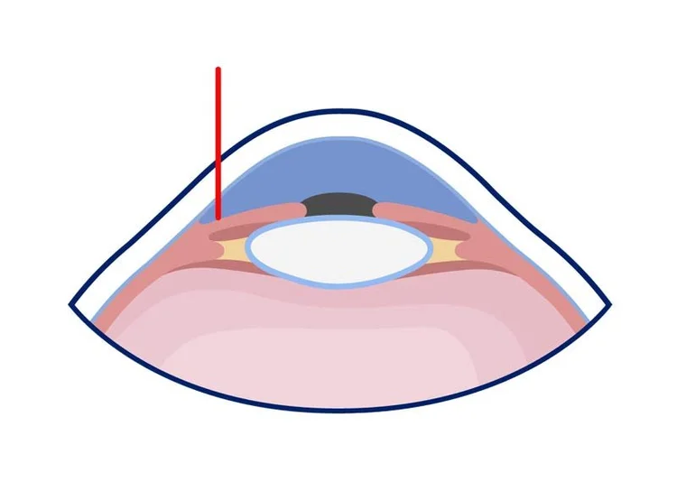 Laser Peripheral Iridotomy — Dublin Eye Surgeon - Pavi Agrawal