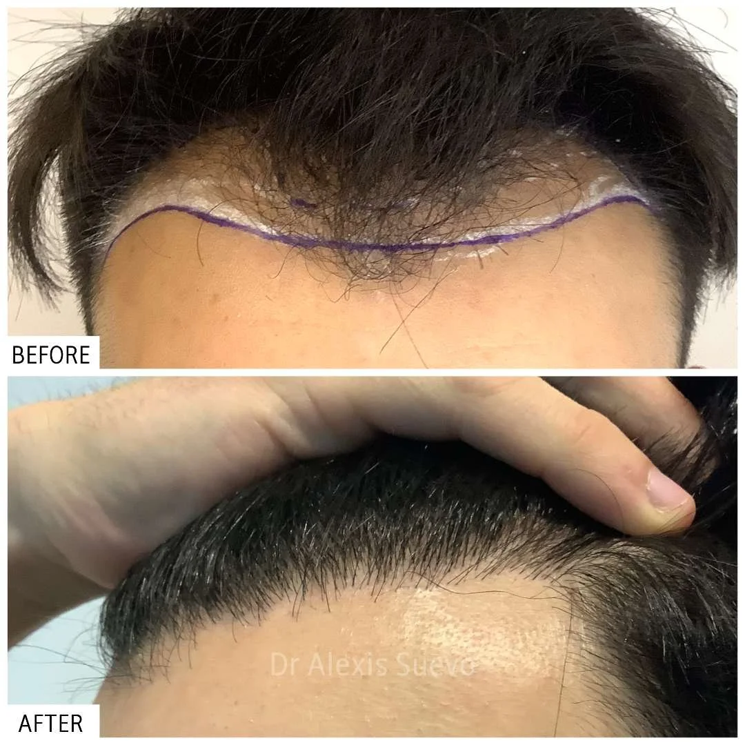Before & After of Natural FUE Hair Transplant Results - Anagen Hair ...