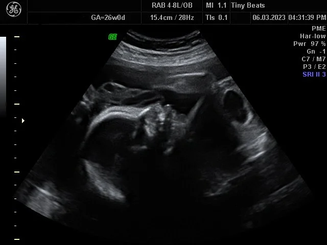 2D Ultrasound Sessions — Tiny Beats 3D Ultrasound