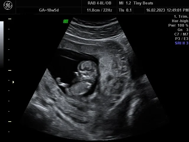 2D Ultrasound Sessions — Tiny Beats 3D Ultrasound