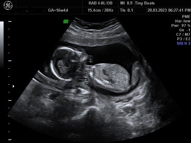 16 Week Ultrasound 3d