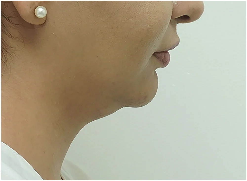 Fat Freezing Before and After I Villanova Contour