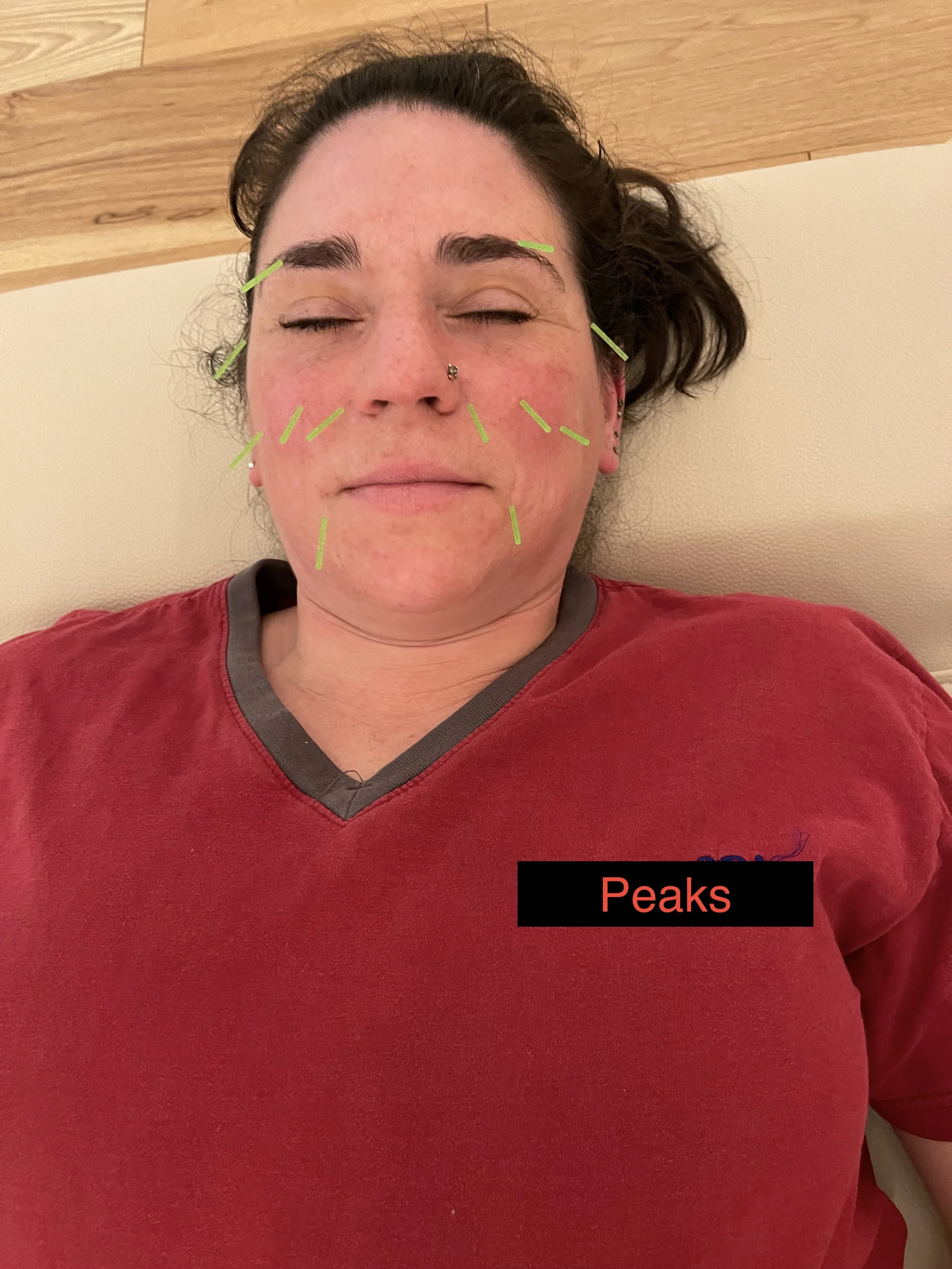 Peaks and Points Acupuncture and Integrative Health | Acupuncture in ...