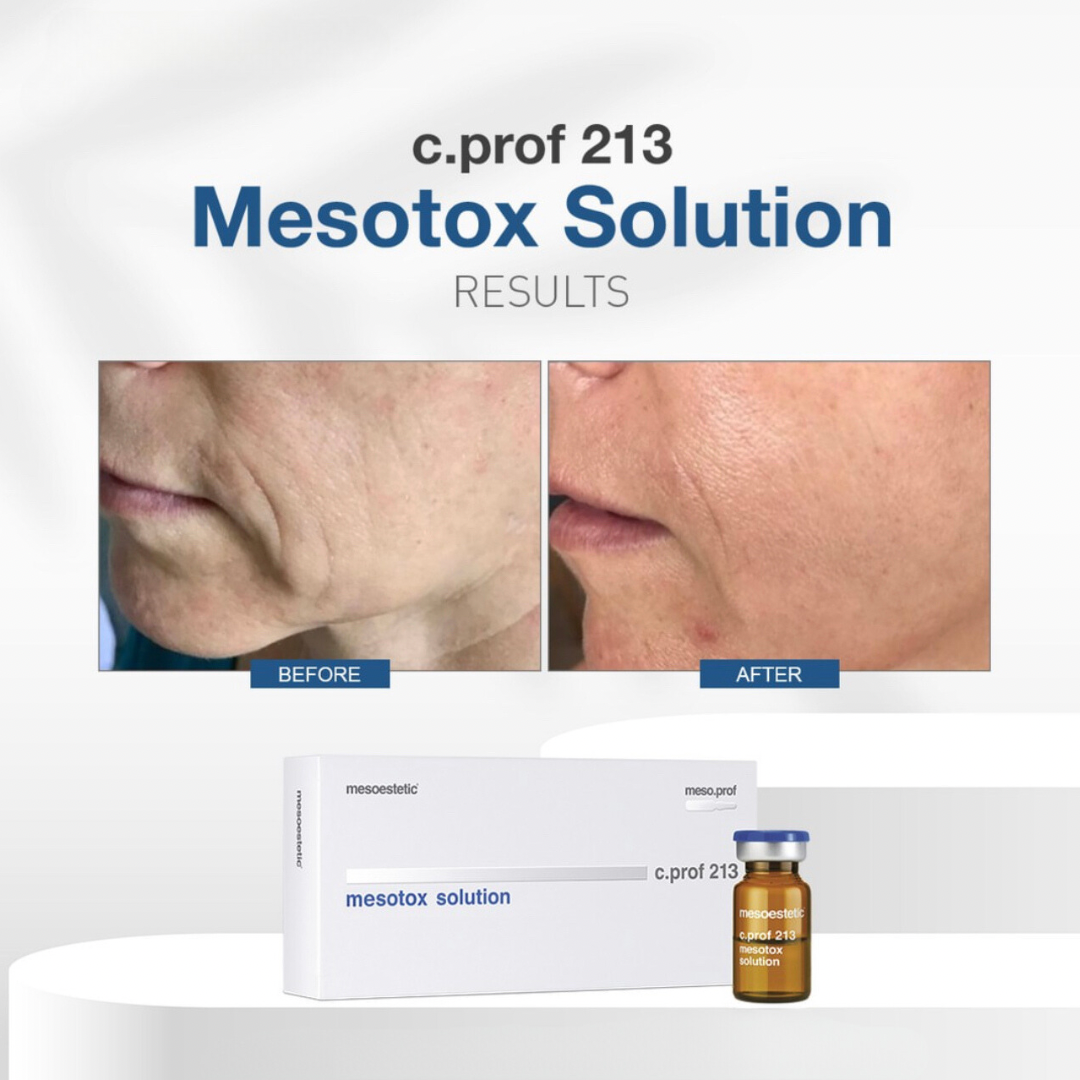 Mesotox — Platinum Beauty And Skin Clinic