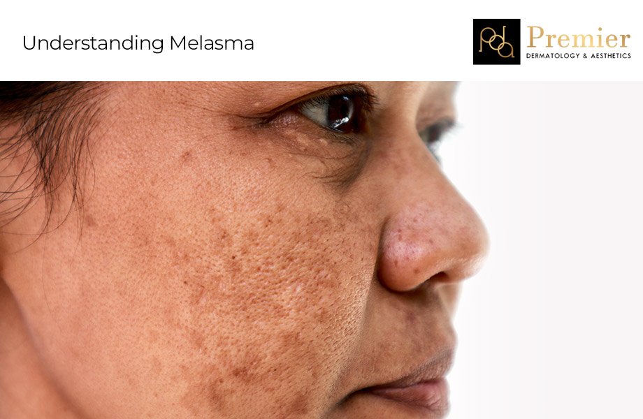 Melasma Treatment in NYC | Premier Dermatology & Aesthetics — Premier ...