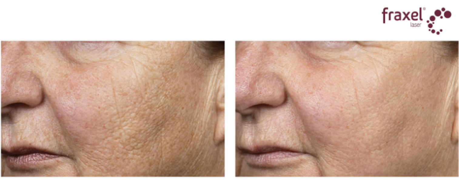 Fraxel Dual NYC | Laser Resurfacing for Pigment, Texture & Scars ...