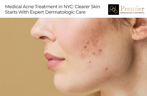 Medical Acne Treatment in NYC | Premier Dermatology & Aesthetics ...