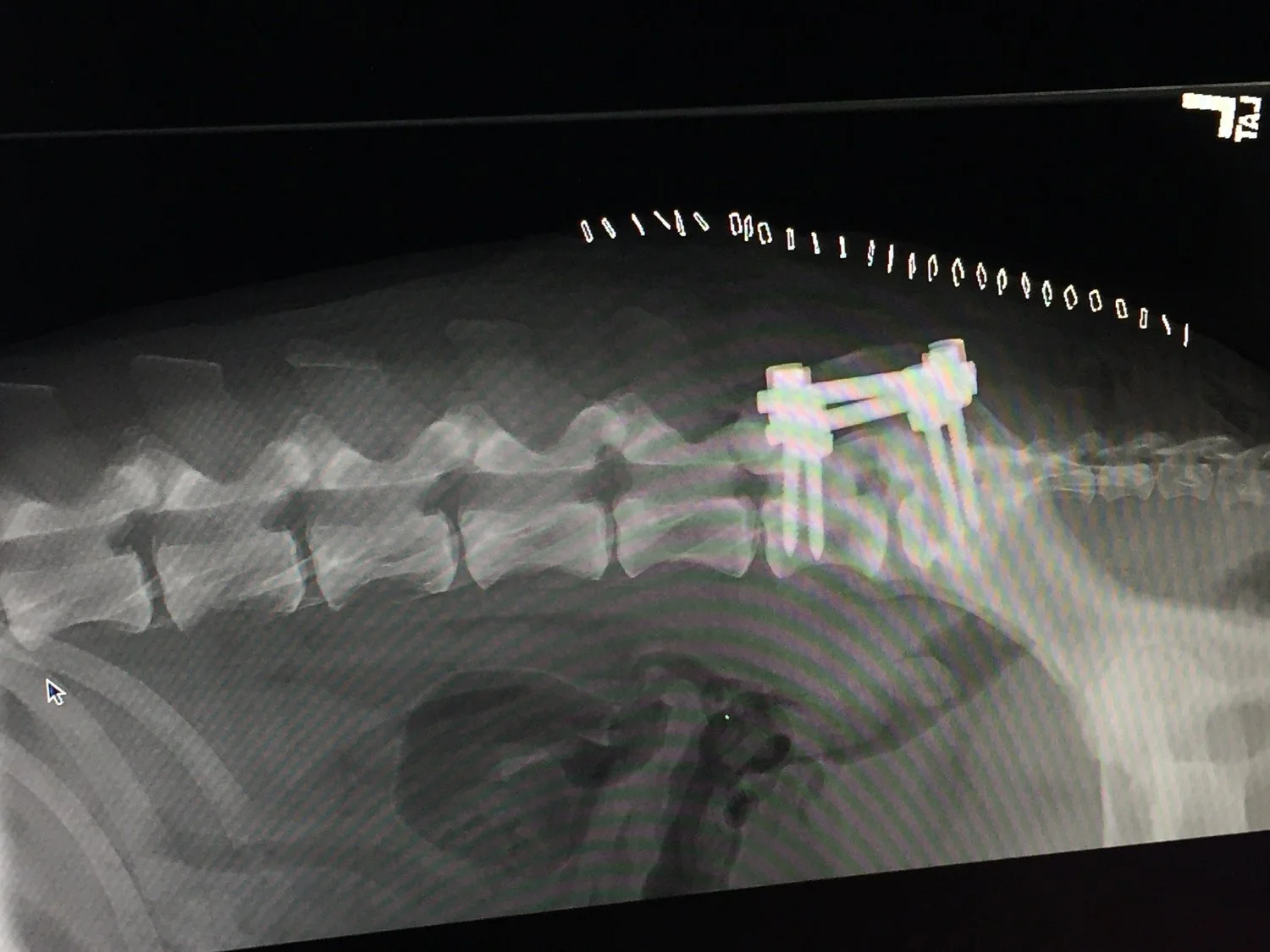 Spinal Stabilization — ArteMedics