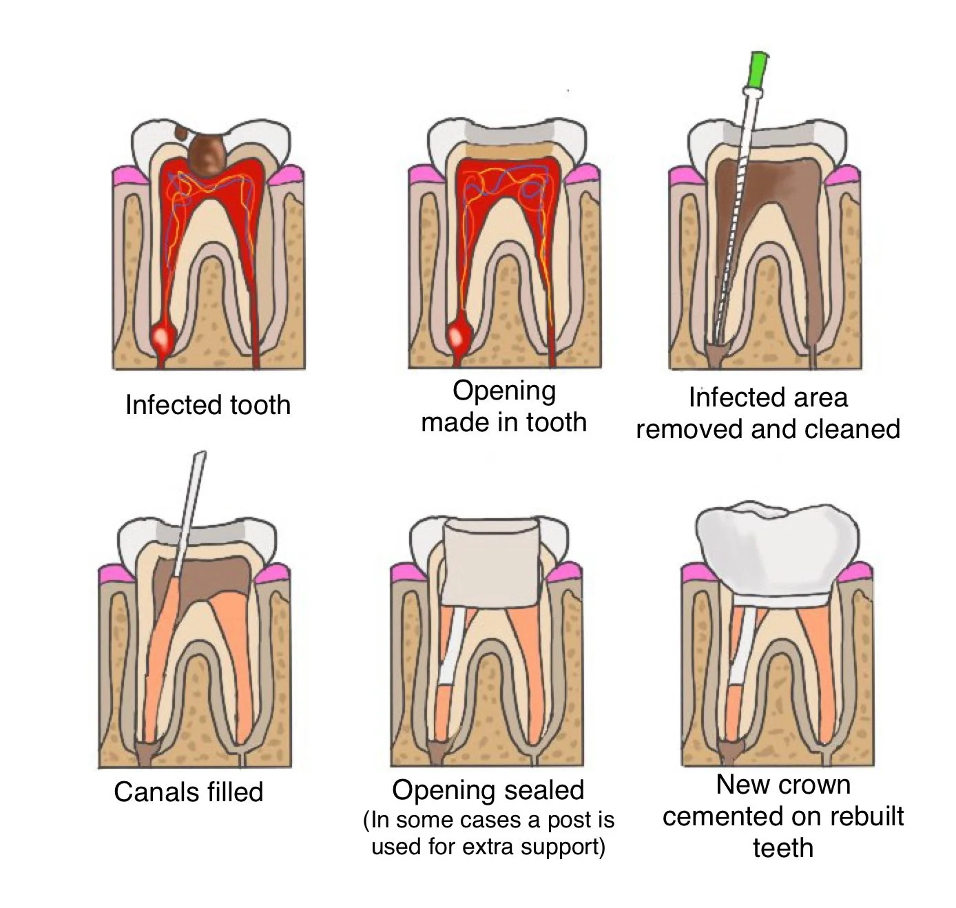 What is a root canal? Why do I need one? (Endodontics) — Dental Day