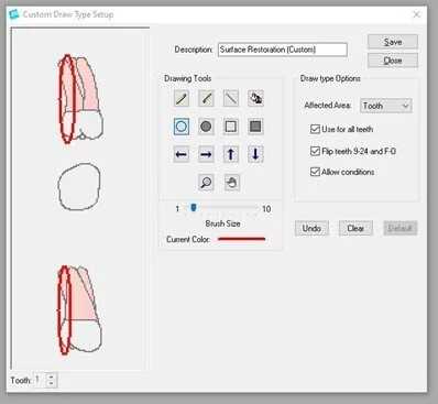 Andre's Supernumerary Tooth Charting and Billing in Eaglesoft — THE ...