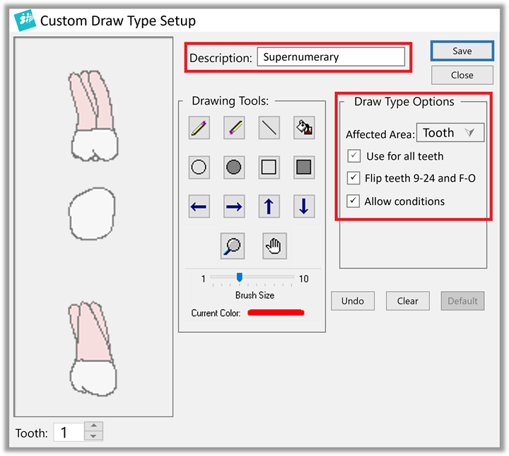 Andre's Supernumerary Tooth Charting and Billing in Eaglesoft — THE ...