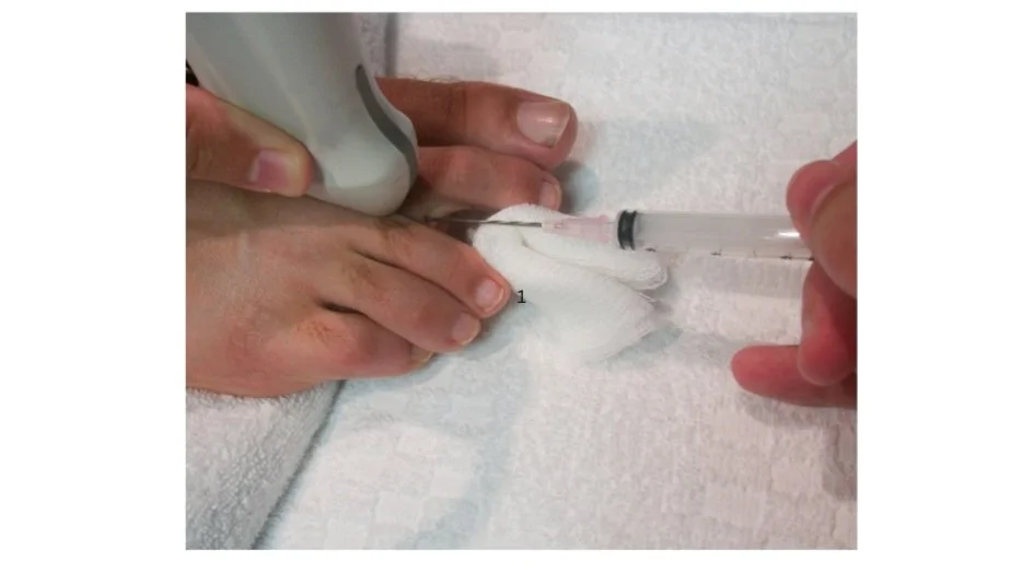 Morton Neuroma: Causes, Symptoms, and Diagnosis with Ultrasound Scans ...