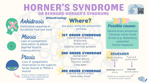 Horner's syndrome — Neudrawlogy: Simplifying Neurology