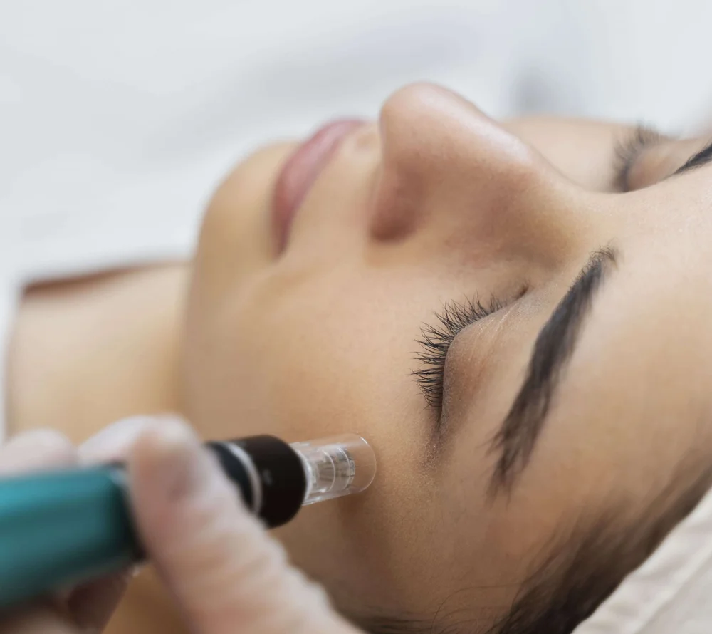 What is Microneedling with PRP? Detailed Guide | Aestheticus