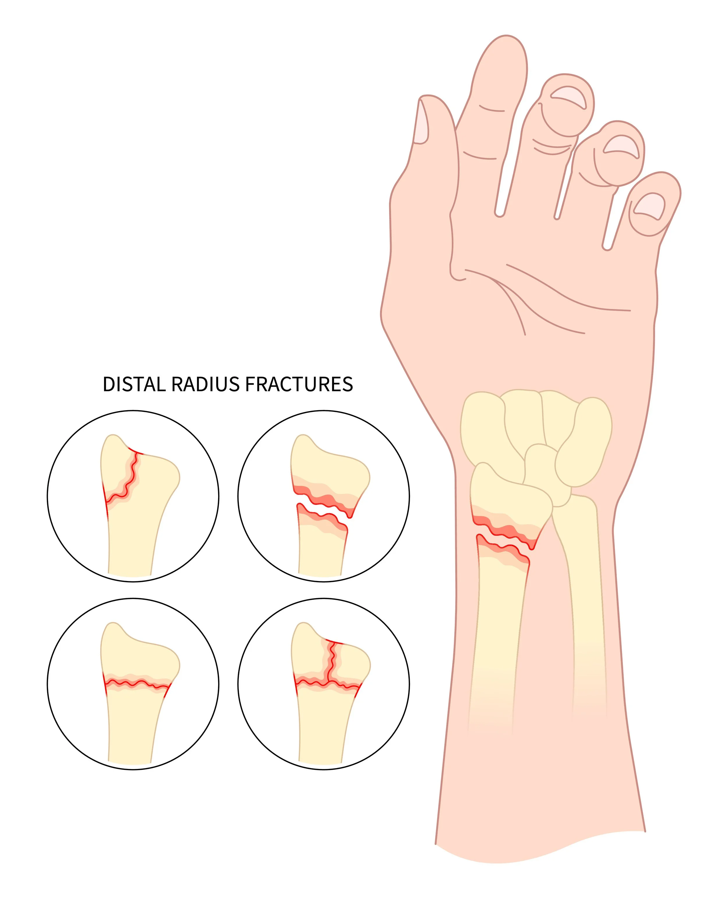 Operative Distal Radial Fractures: A Comparison of Time to Surgery ...