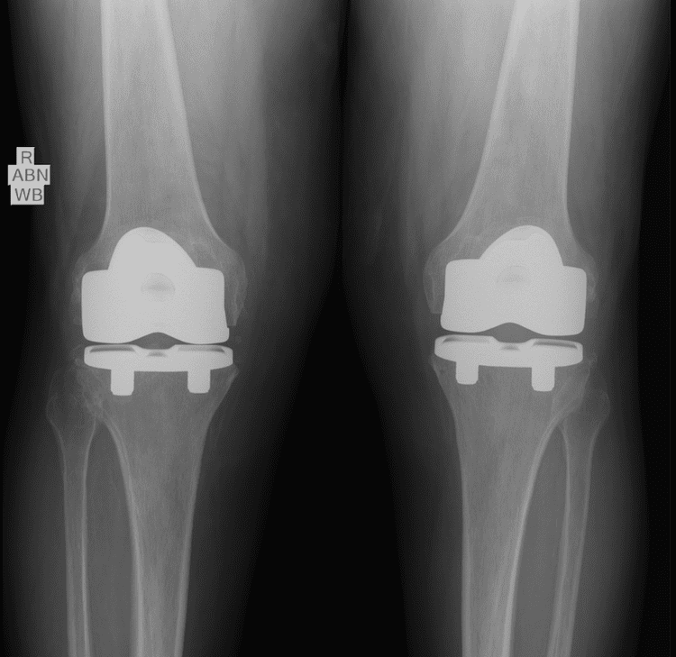 Dr. Horberg Joint Replacement Surgery — Premier Bone & Joint Centers