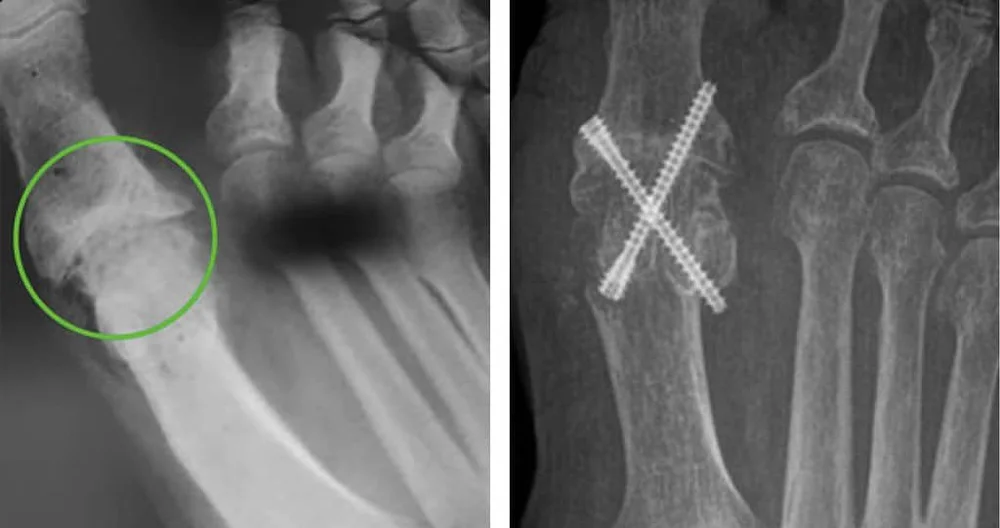 OSSIOfiber - Naturally Transformative Bone Healing — Premier Bone ...