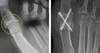 OSSIOfiber - Naturally Transformative Bone Healing — Premier Bone ...