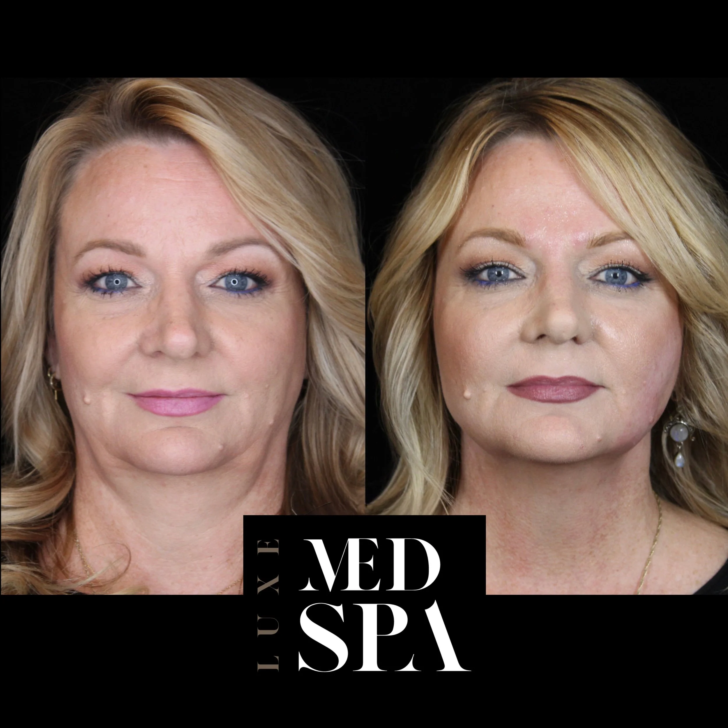 PDO THREADS — Luxe Med Spa Aesthetics