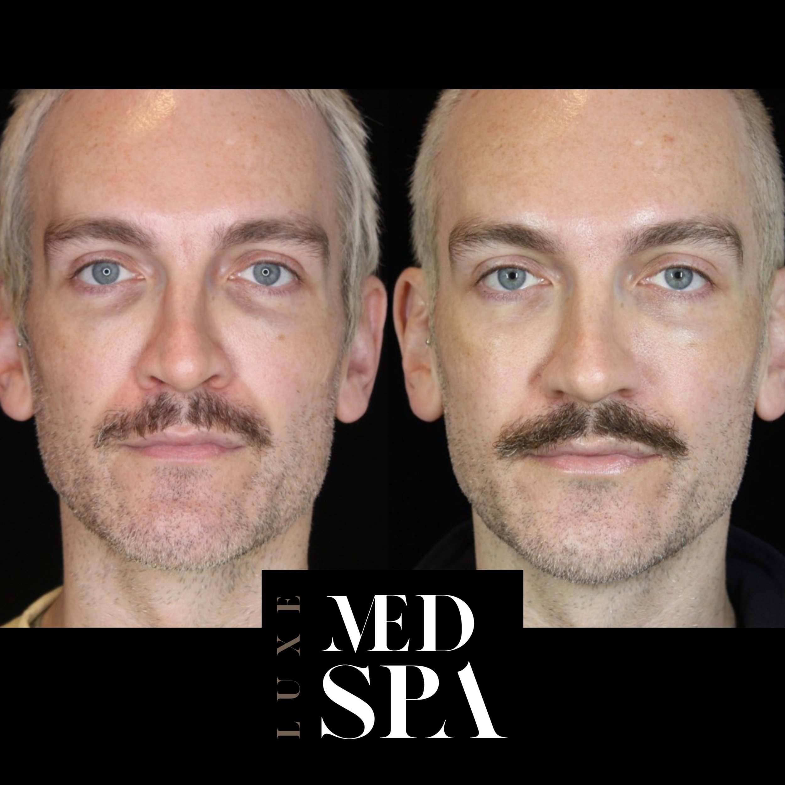 NATURAL GROWTH FACTOR INJECTIONS (PRP/PRF) — Luxe Med Spa Aesthetics