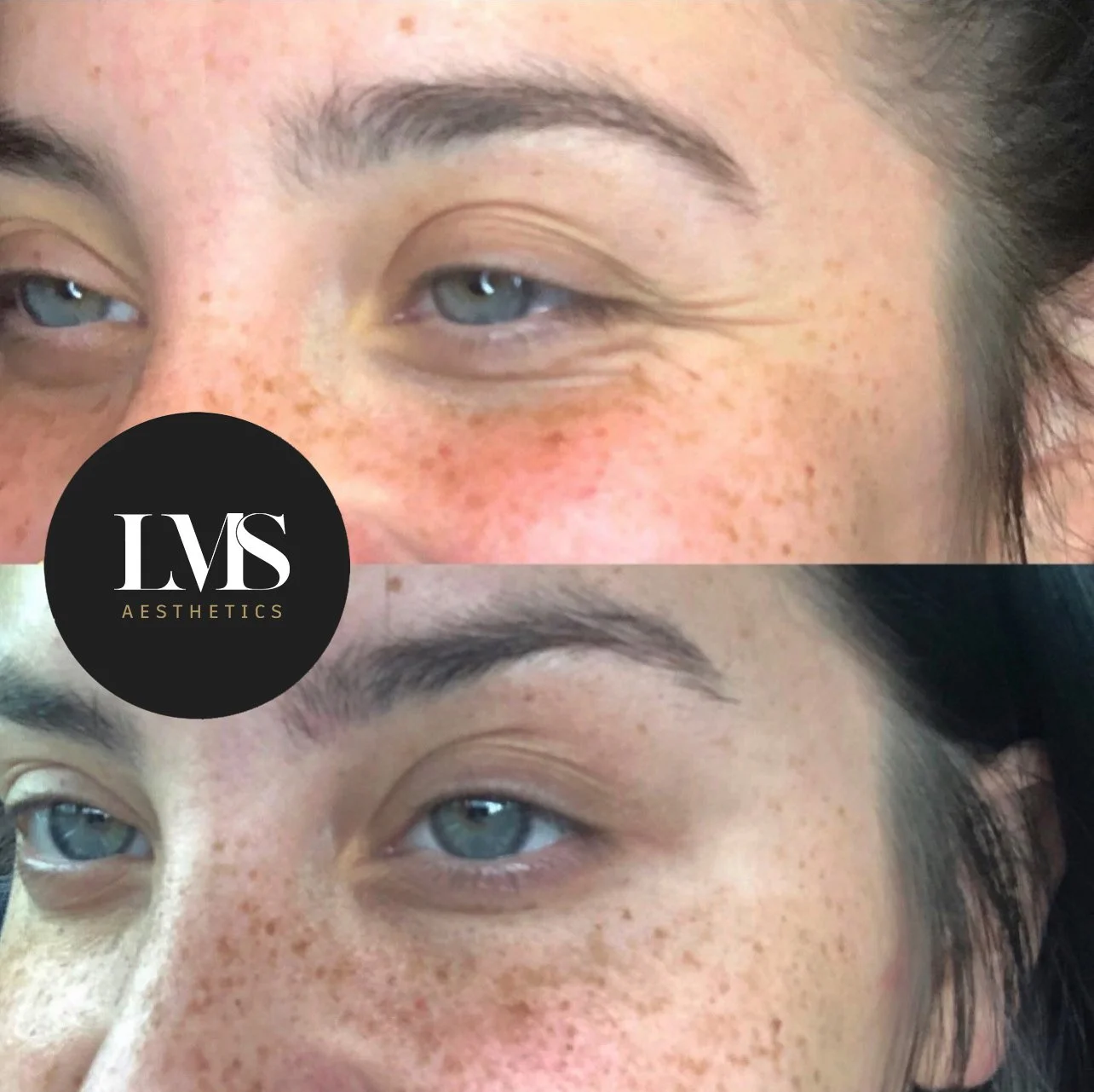 NEUROMODULATORS ( i.e. Botox) — Luxe Med Spa Aesthetics