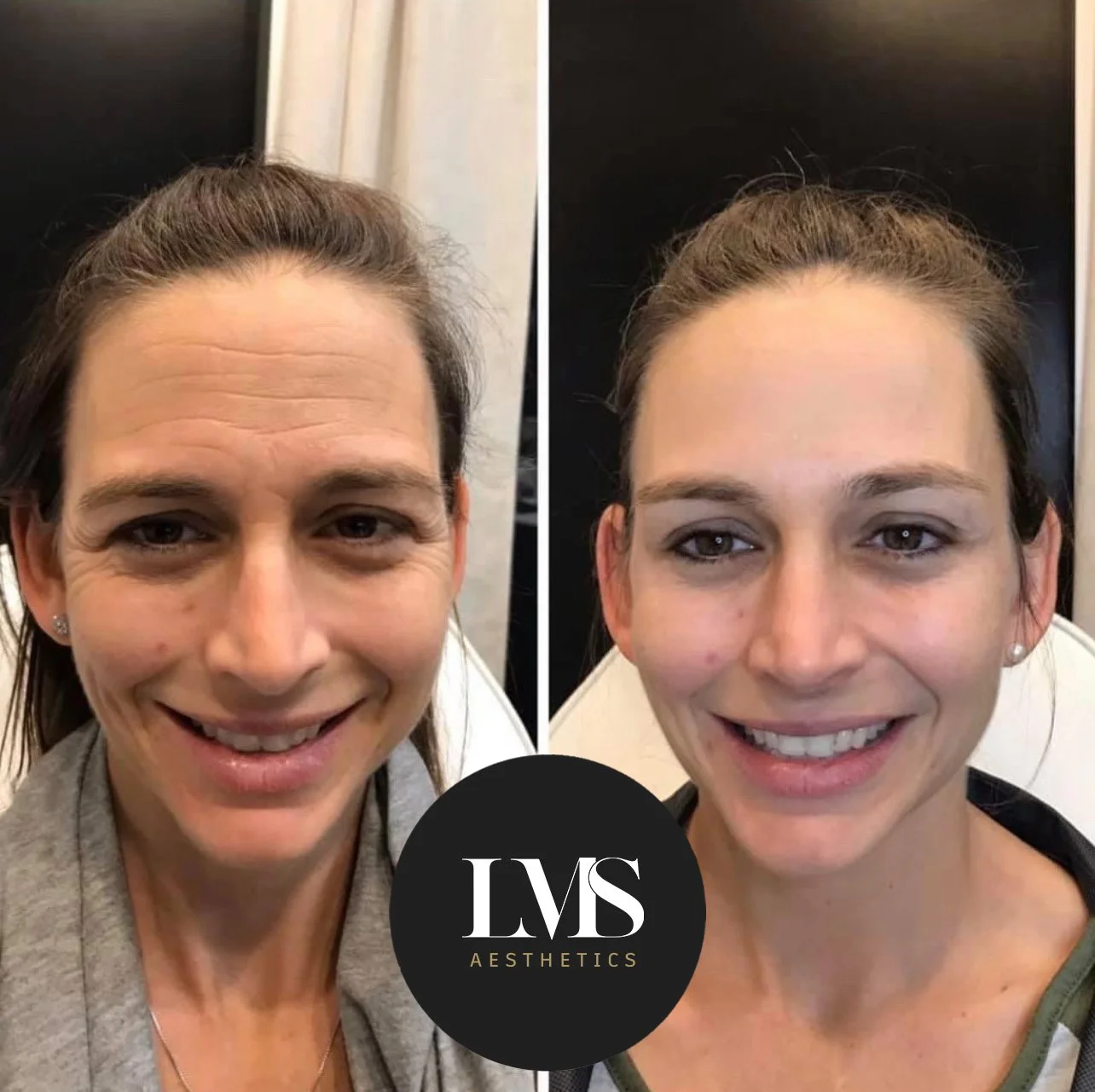 NEUROMODULATORS ( i.e. Botox) — Luxe Med Spa Aesthetics