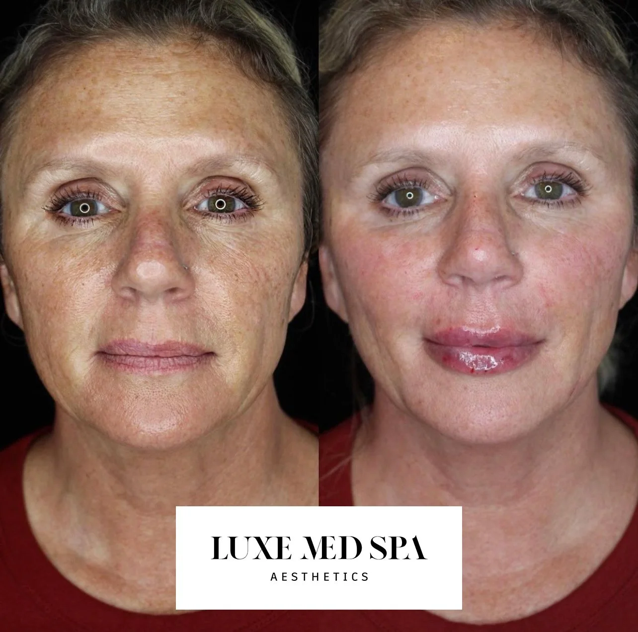 PDO THREADS — Luxe Med Spa Aesthetics