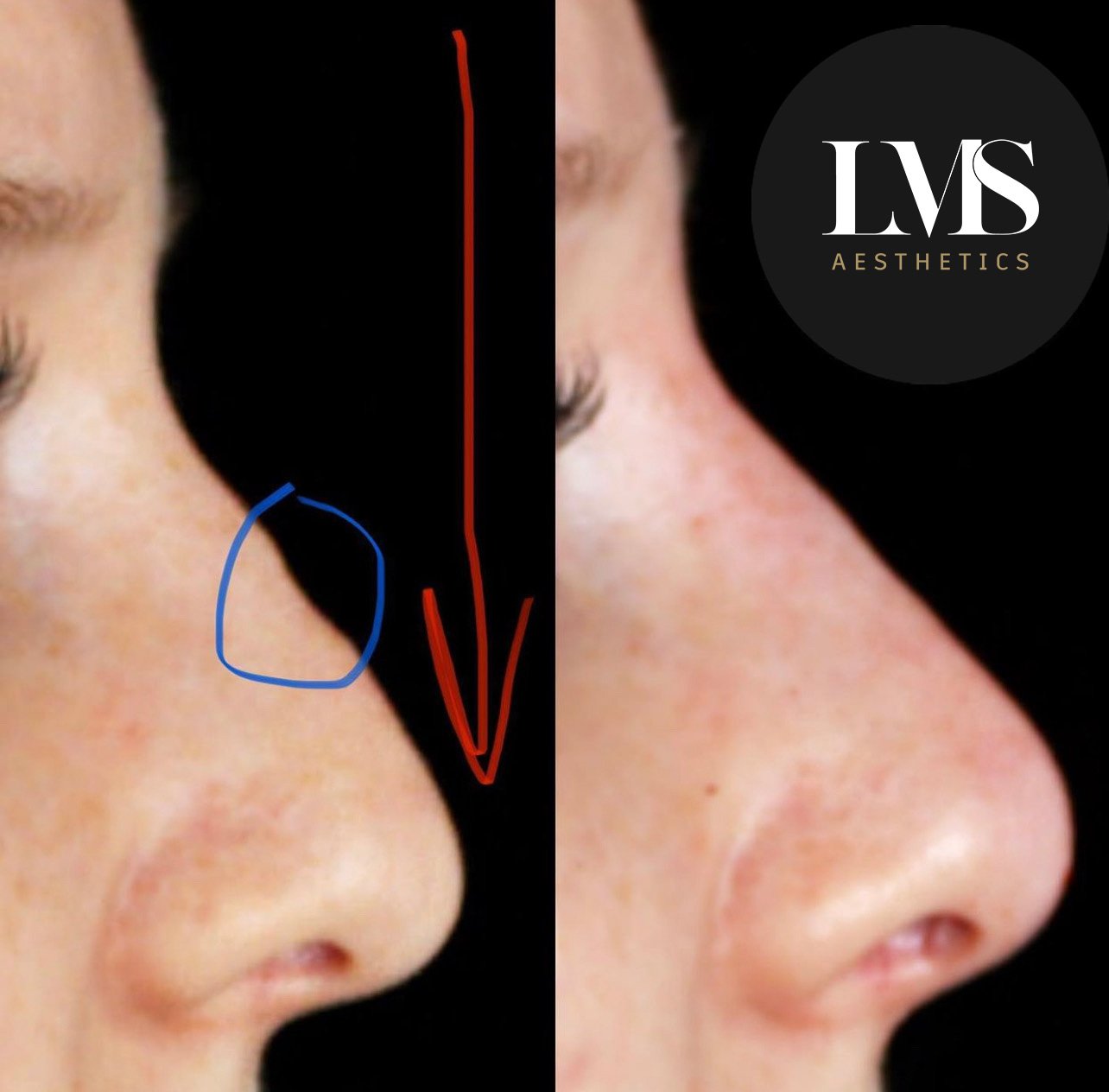 PDO THREADS — Luxe Med Spa Aesthetics