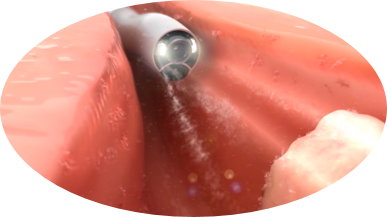 How Aveta™ System Works — Aveta® System