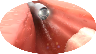 How Aveta™ System Works — Aveta® System