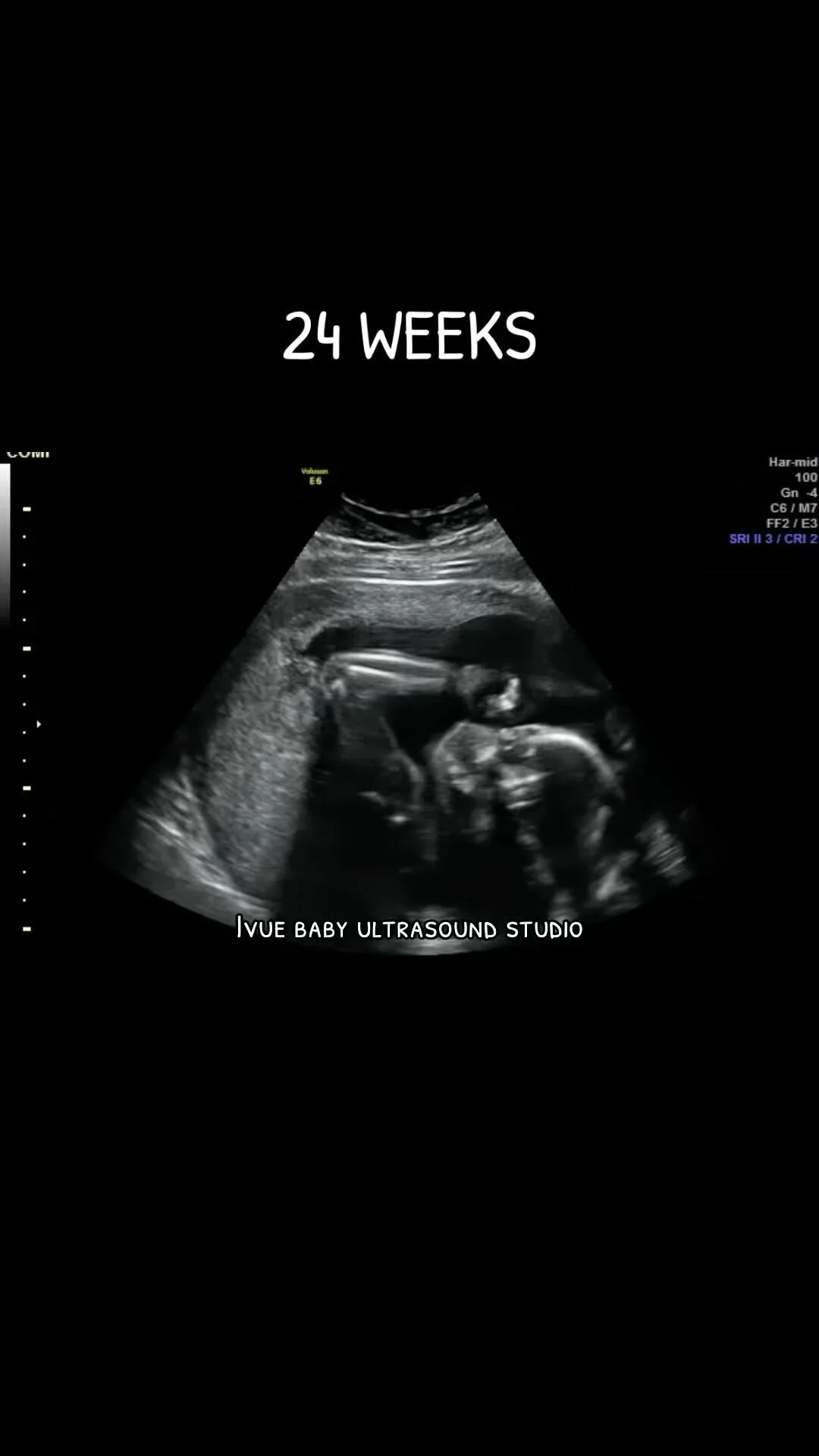 Ivue Baby We Provide 3D 4D 5D Ultrasound Gender Determination Test ivue-baby-we-provide-3d-4d-5d-ultrasound-gender-determination-test