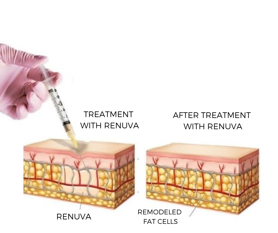 Botox, Daxxify, Jeuveau in Issaquah | Wrinkle Treatment — VITAL AESTHETICS