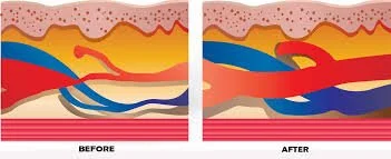 TriForce Wave Therapy