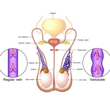 Male Infertility Part 1: Varicocele — Male Pelvis Center