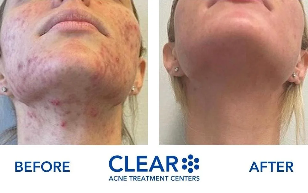 Get Treatment Estimate | CLEAR Acne Treatment Centers