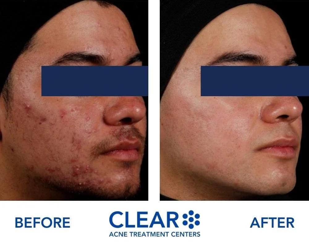 Get Treatment Estimate | CLEAR Acne Treatment Centers