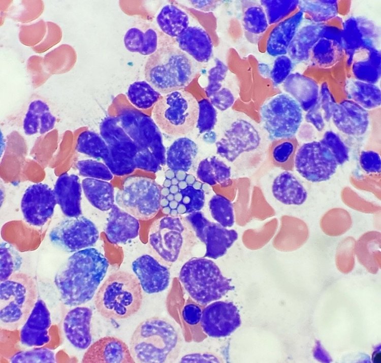 Hematology — Heme Onc Notes