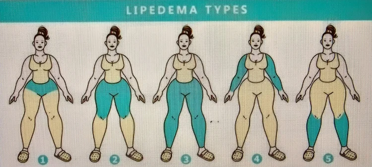 Lipedema Types — Love and Lipedema Awareness