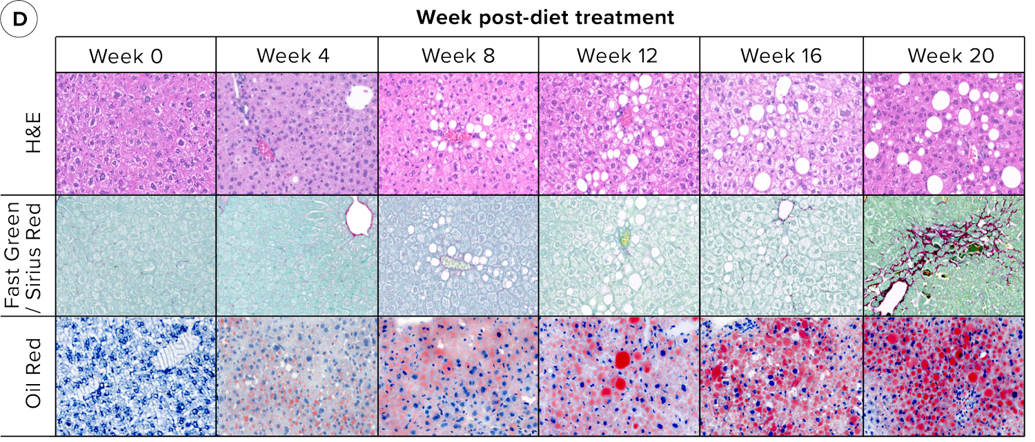 Non-Alcoholic Steatohepatitis (NASH) | Explore NASH Solutions Today ...