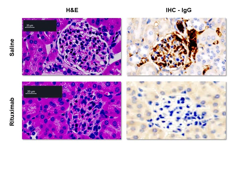 Systemic Lupus Erythematosus (SLE) — Invivocue | Leading expert in ...