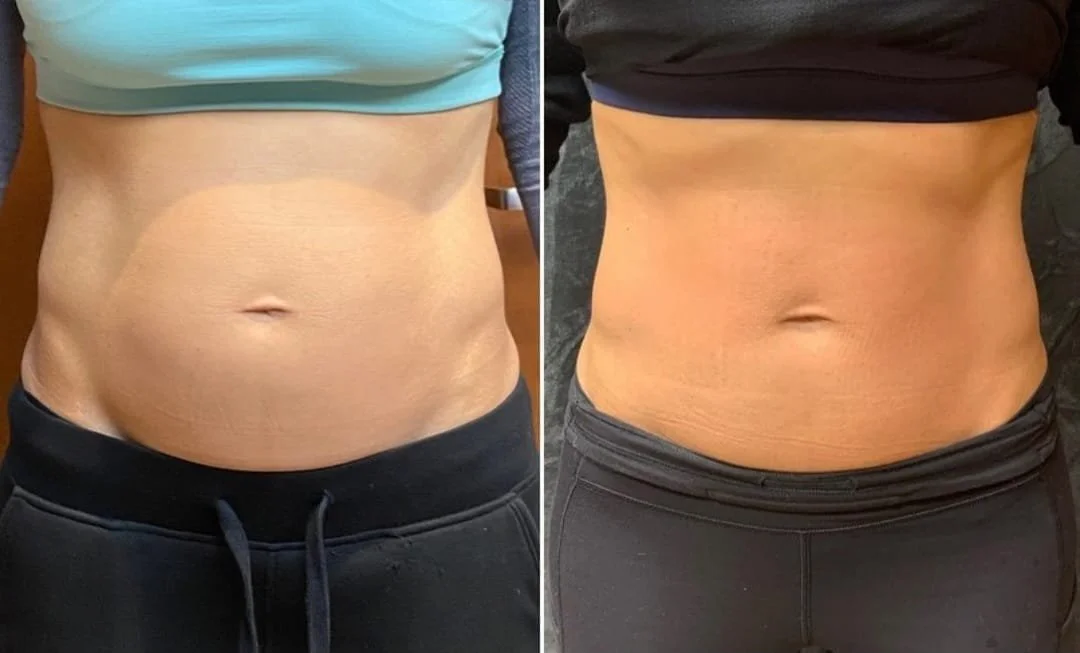 Evolve X Non-Surgical Body Contouring | Bella Vista NSW
